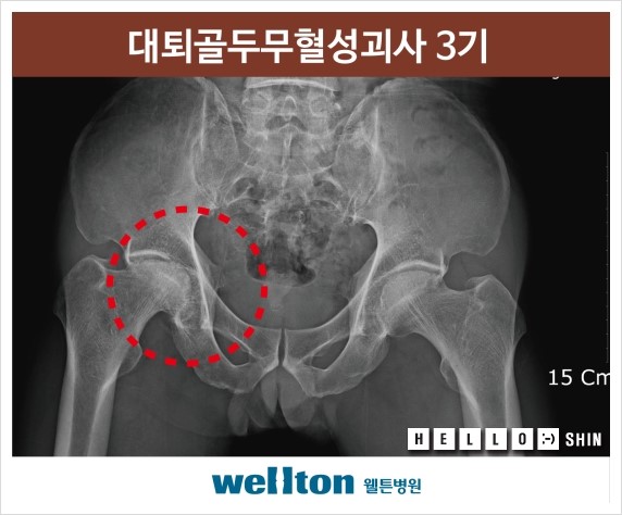 고관절 대표질환 대퇴골두무혈성괴사 증상과 원인 치료까지 네이버 블로그