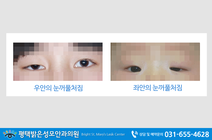눈꺼풀처짐 증상 원인 And 수술 시기는 네이버 블로그