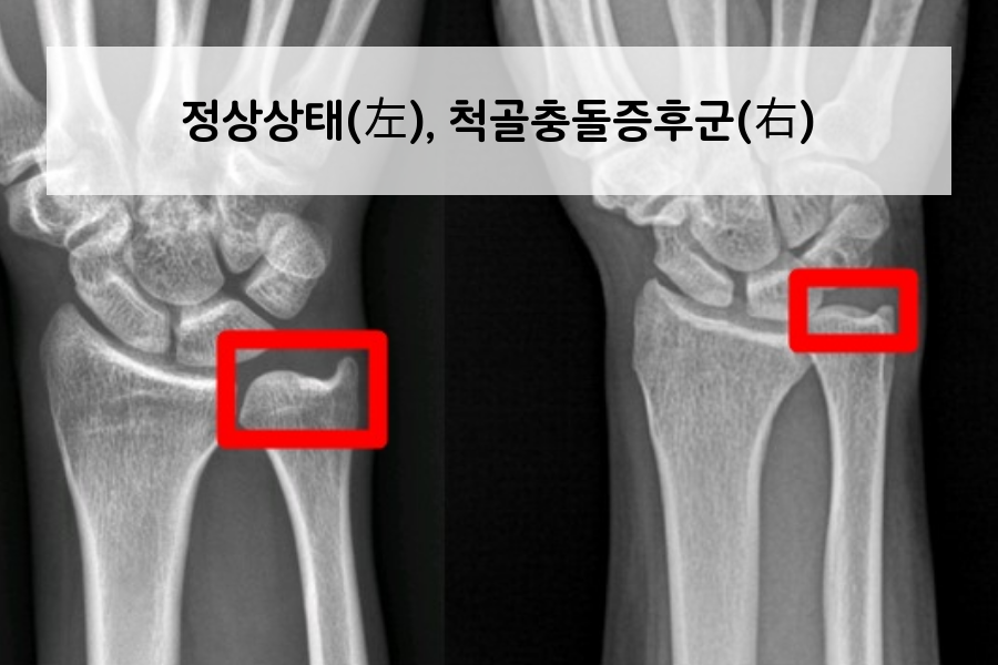 1 Tfcc파열을 동반하는 척골충돌증후군 한꺼풀 벗겨보면 네이버 블로그