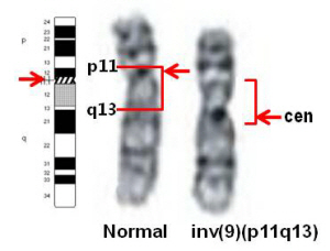 9번 염색체의 협동원체 역위 inv(9)(p11q13) : 네이버 블로그