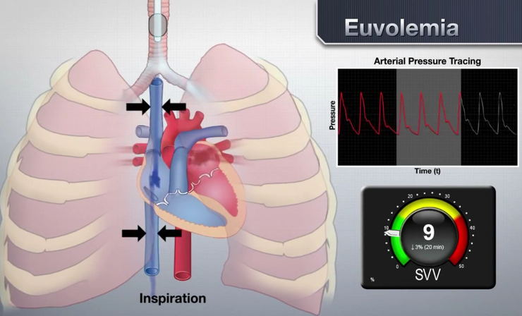 Stroke volume variation : 네이버 블로그