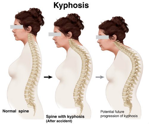 척추후만증(kyphosis)에 따른 근골격계의 형태적 변화와 운동방법 part. Ⅰ : 네이버 블로그