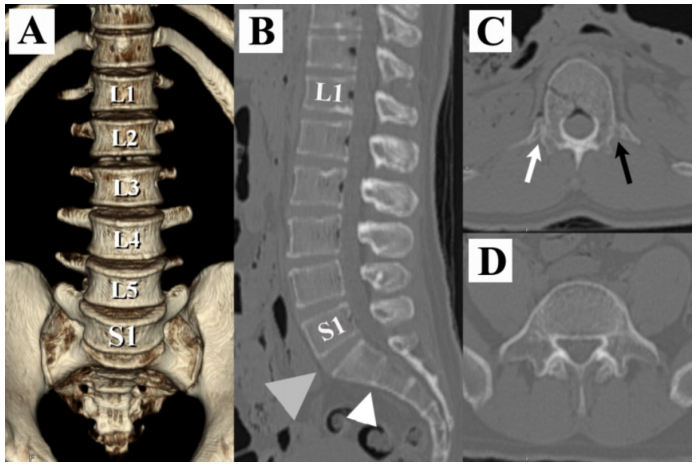 lumbosacral transitional vertebrae (LSTV: lumbarization and ...